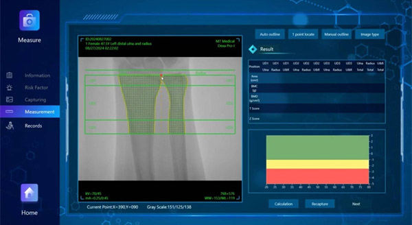 News - Which brand of bone density meter software is good to use?